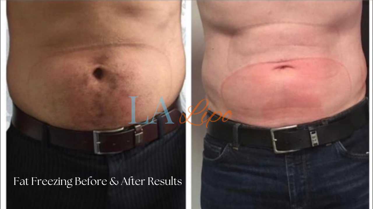 Before & After Cryolipolysis Results