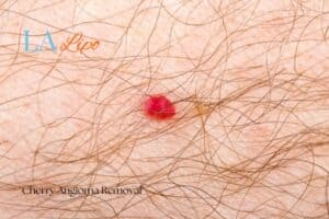 Cherry Angioma Removal Service