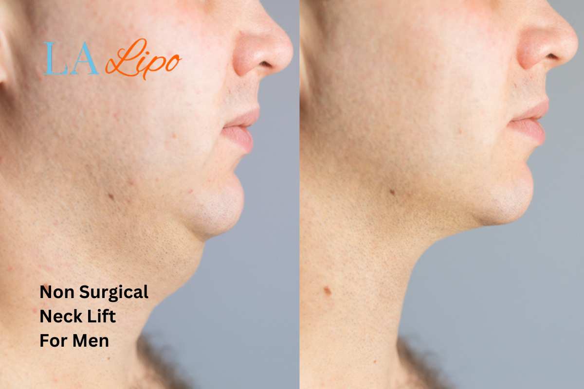 Mens Neck Fat Toning Treatment